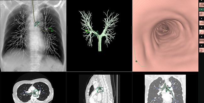 3D Pulmonology | Fujifilm Healthcare