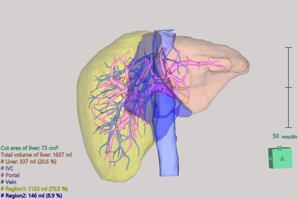 HPB Surgery | Fujifilm Healthcare