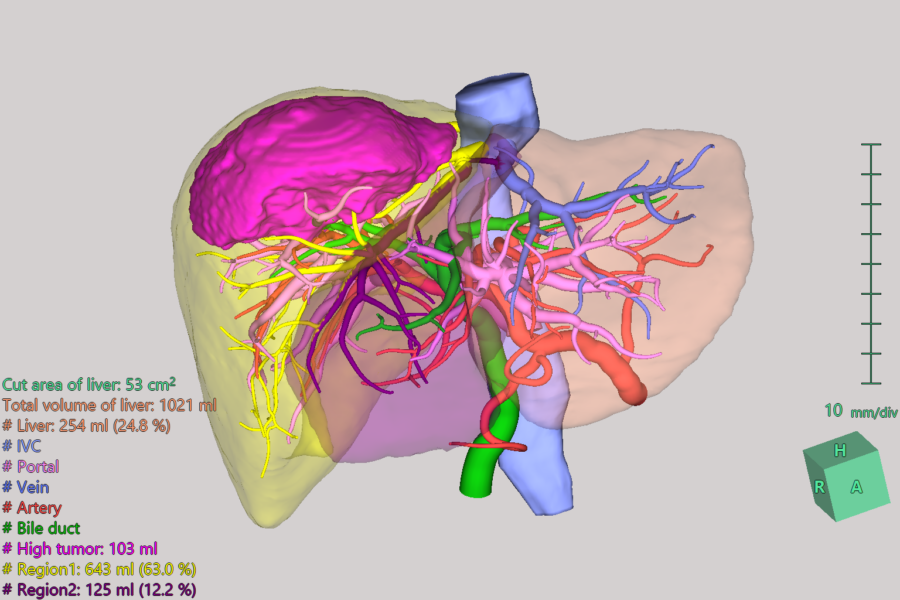 HPB Surgery | Fujifilm Healthcare
