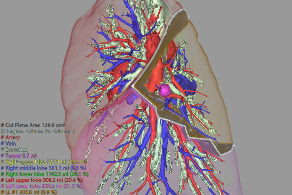 Lung Surgery | Fujifilm Healthcare