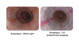 Interventional Gastro Video Imaging System | Fujifilim ELUXEO